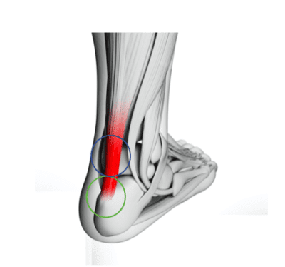 Shockwave Therapy for Insertional Achilles tendinopathy