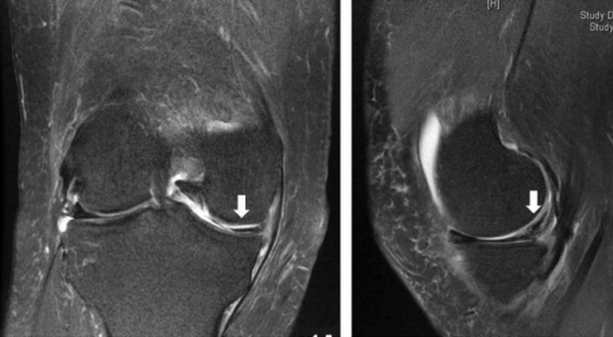 What is a meniscal tear? | Complete Physio