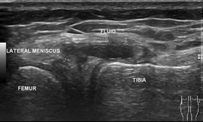 What is a meniscal tear? | Complete Physio