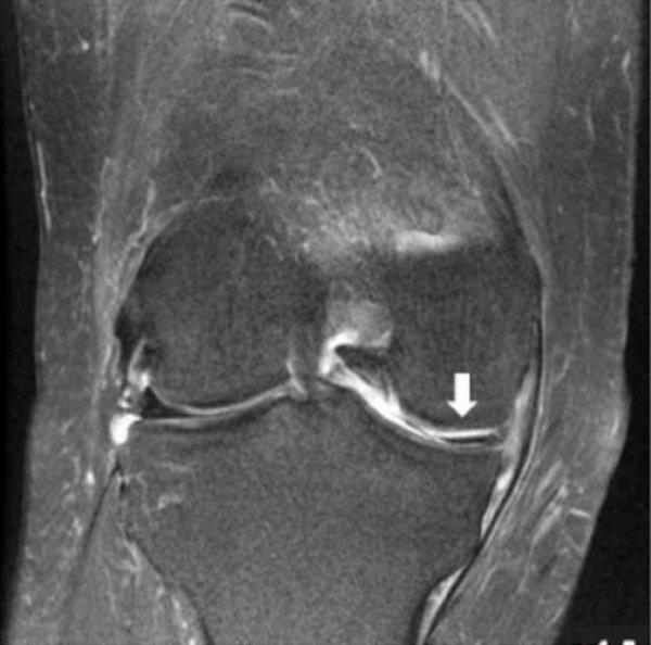 Meniscus Injuries - Everything you need to Know | Complete Physio