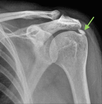 Calcific Tendinitis of the Shoulder | Complete Physio