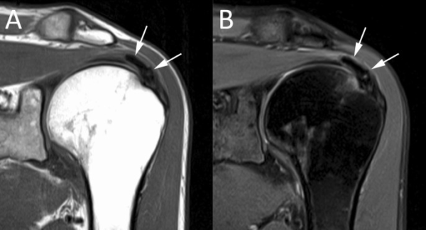 Calcific Tendinitis of the Shoulder | Complete Physio