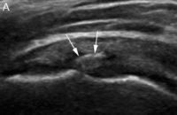 Calcific Tendinitis of the Shoulder | Complete Physio