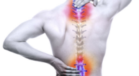 Spondylosis (Osteoarthritis) of the Spine | Complete Physio