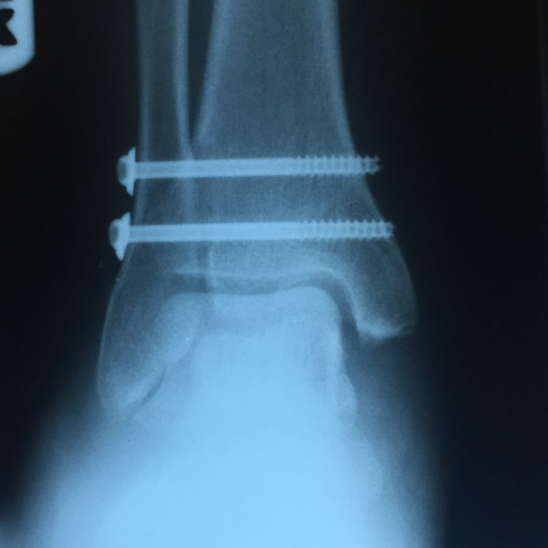 High Ankle Sprain (Syndesmosis Injury) | Complete Physio
