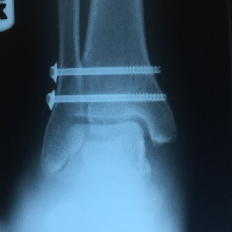 High Ankle Sprain (Syndesmosis Injury) | Complete Physio