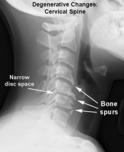 Spondylosis (Osteoarthritis) of the Spine | Complete Physio