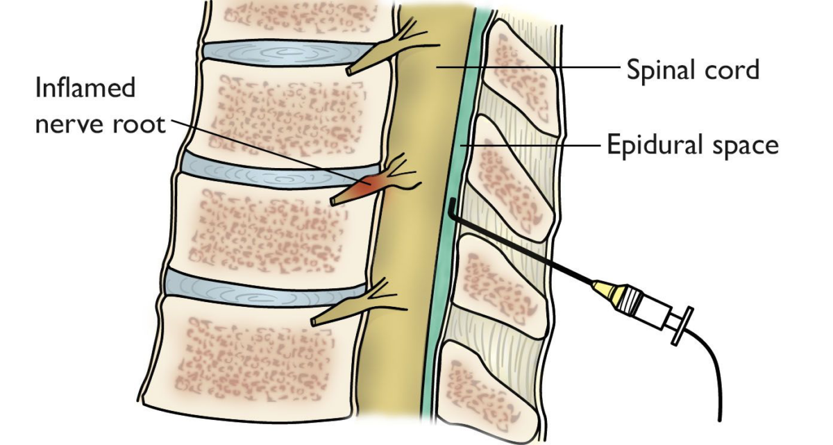 Spondylosis (Osteoarthritis) of the Spine | Complete Physio