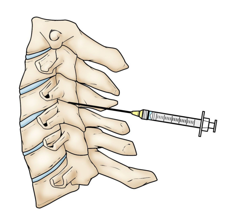 Spondylosis (Osteoarthritis) of the Spine | Complete Physio