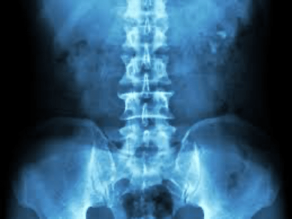 Piriformis Syndrome | Complete Physio