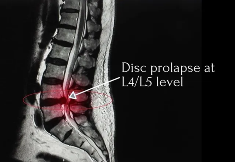 Sciatica | Complete Physio