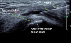 Greater Trochanteric Pain Syndrome - GTPS (also known as Trochanteric ...