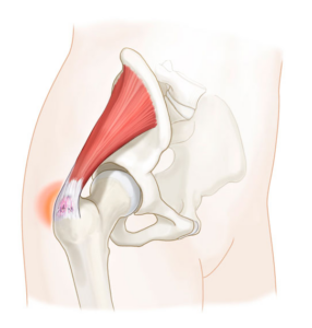 Greater Trochanteric Pain Syndrome - GTPS (also known as Trochanteric ...