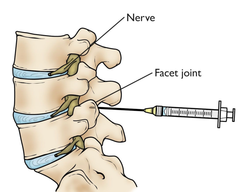 Cervical Facet Joint Pain | Complete Physio