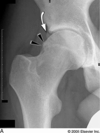 Femoroacetabular Impingement (FAI) | Complete Physio
