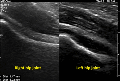 Femoroacetabular Impingement (FAI) | Complete Physio